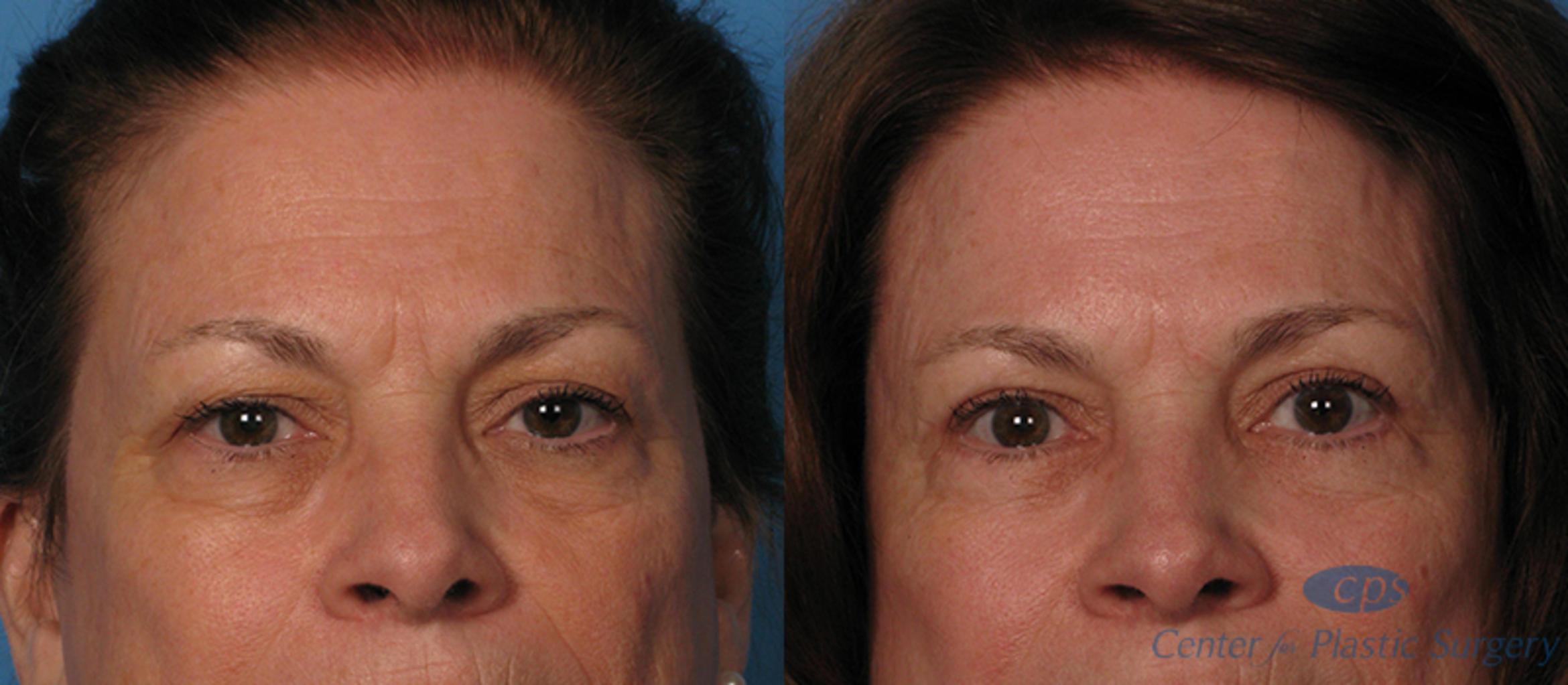 Eyelid Surgery (Blepharoplasty) for Washington, DC & Chevy Chase, MD ...